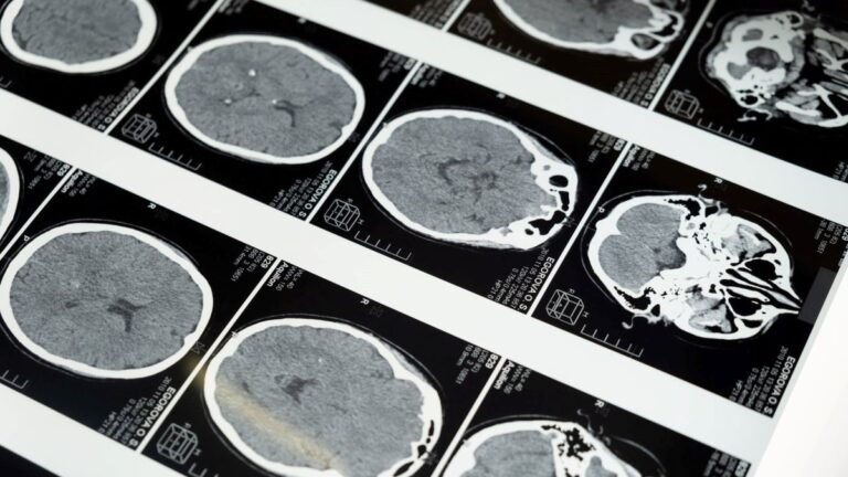 Mapping traumatic brain injury patterns with neuroimaging - News ...